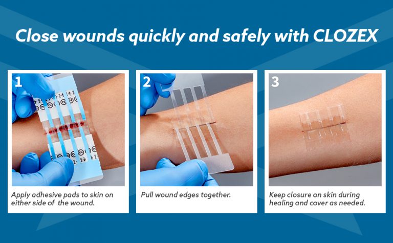 Sanare offers Clozex Medical wound closure device